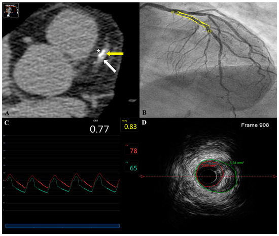Bioresorbable Magnesium-Based Stent: Real-World Clinical Experience and ...
