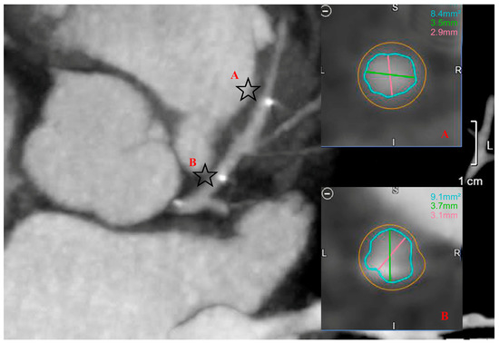 Bioresorbable Magnesium-Based Stent: Real-World Clinical Experience and ...