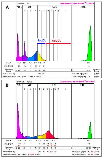 Small Dense LDL Level and LDL/HDL Distribution in Acute Coronary ...