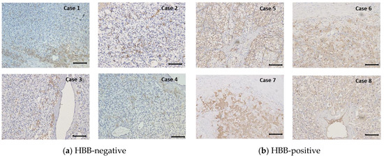Hemoglobin β Expression Is Associated with Poor Prognosis in Clear Cell ...