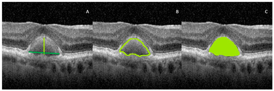 Advanced ImageJ Analysis in Degenerative Acquired Vitelliform Lesions ...