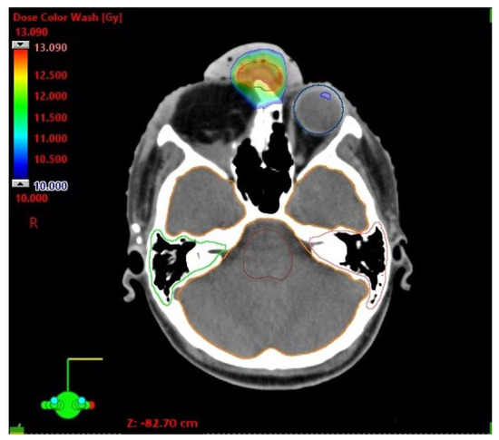 Stereotactic Radiotherapy Boost in Treatment of Persistent Periocular ...
