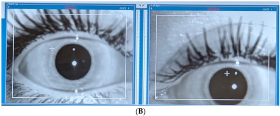 Neuromodulation of the Autonomic Nervous System in Chronic Low Back ...