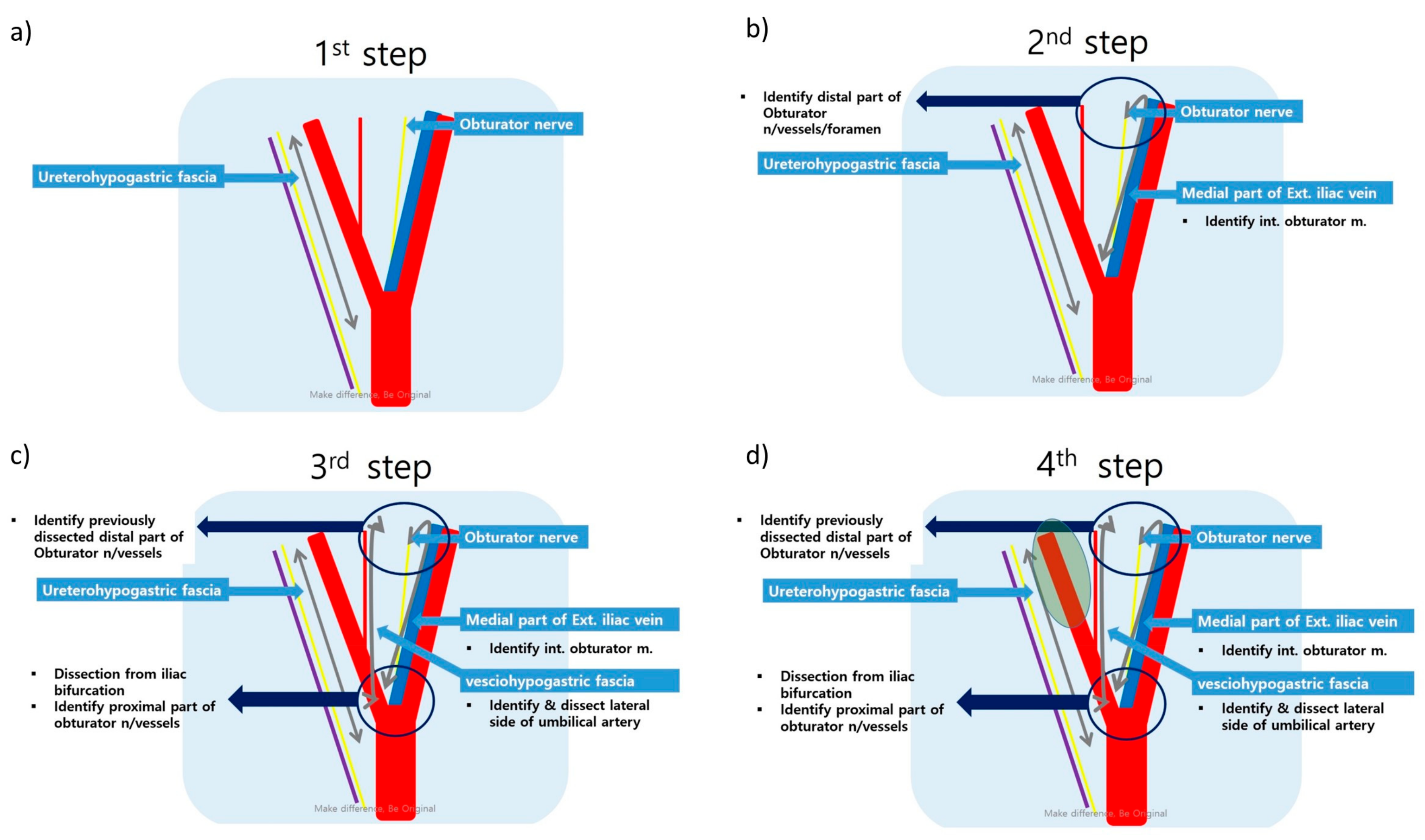 Biomedicines Free Full Text Robotic Lateral Pelvic Lymph Node