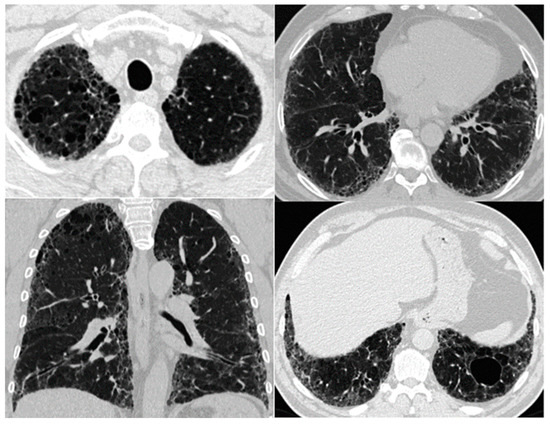 Combined Pulmonary Fibrosis and Emphysema: Comparative Evidence on a ...