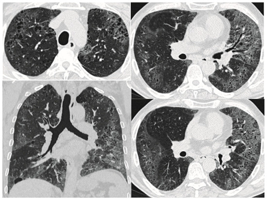 Combined Pulmonary Fibrosis and Emphysema: Comparative Evidence on a ...