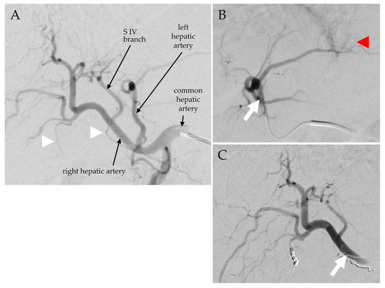 Clinical Results of Transarterial Radioembolization (TARE) with Holmium-166 Microspheres in the ...