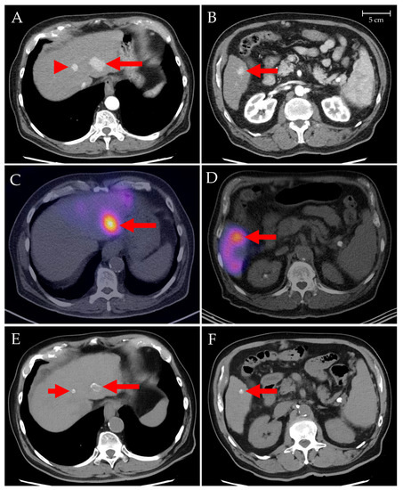 Clinical Results of Transarterial Radioembolization (TARE) with Holmium-166 Microspheres in the ...