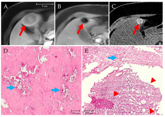 Clinical Results of Transarterial Radioembolization (TARE) with Holmium ...