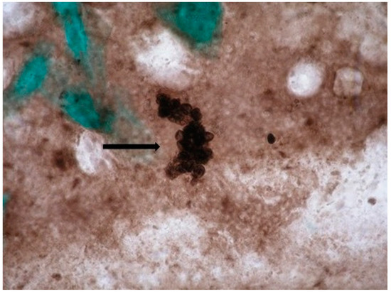 Study on the Prevalence of Pneumocystis jirovecii as a Causative Agent ...