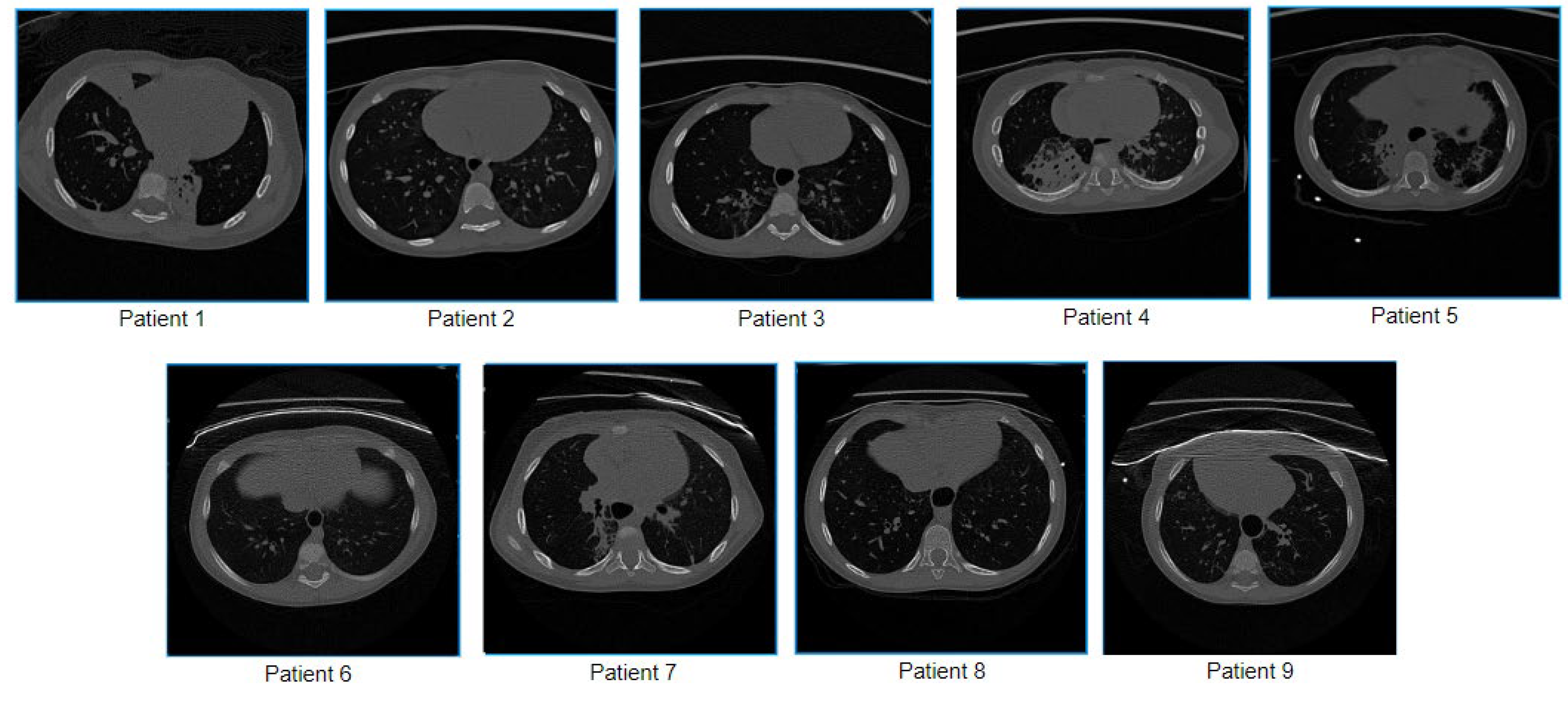 An Automated Broncho-Arterial (BA) Pair Segmentation Process and Assessment of BA Ratios in ...