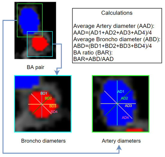 An Automated Broncho-Arterial (BA) Pair Segmentation Process and ...
