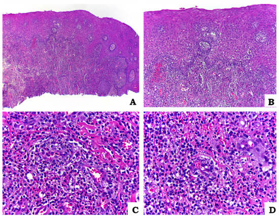 Oral Lesions as the Primary Manifestations of Behçet’s Disease: The ...