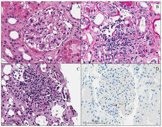 Pathological Approach to Kidney Allograft Infection