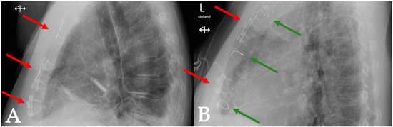 Combined Band and Plate Fixation as a New Individual Option for ...