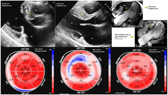 A Family with Myh7 Mutation and Different Forms of Cardiomyopathies