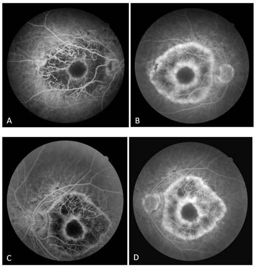 Paramacular Choriocapillaris Atrophy