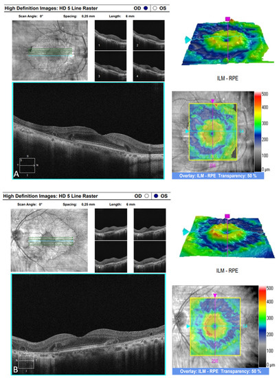 Paramacular Choriocapillaris Atrophy