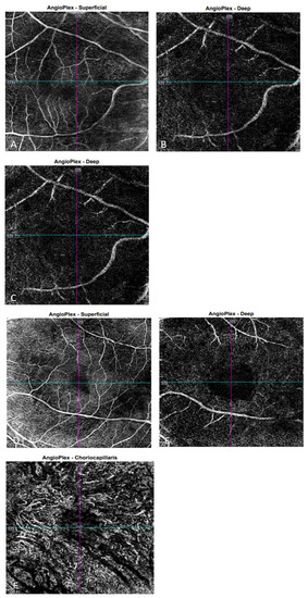 Paramacular Choriocapillaris Atrophy