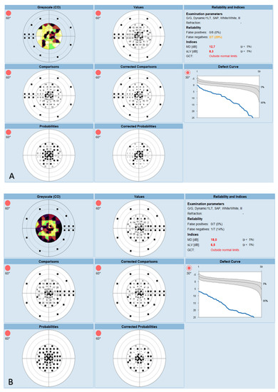 Paramacular Choriocapillaris Atrophy