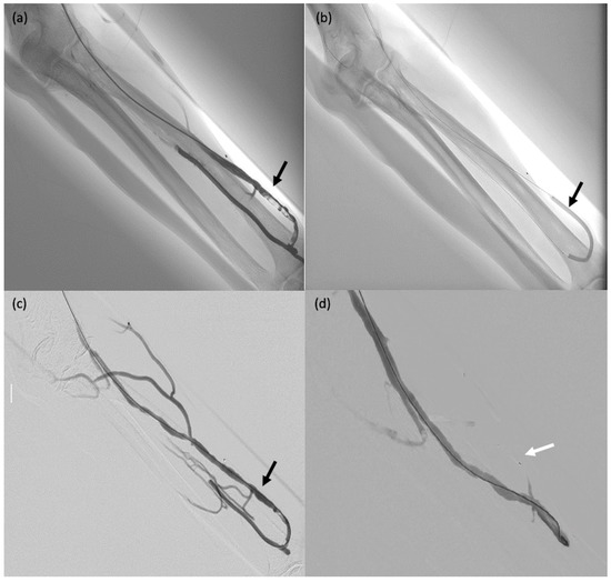 Embolisation Using Microvascular Plugs for Peripheral Applications ...