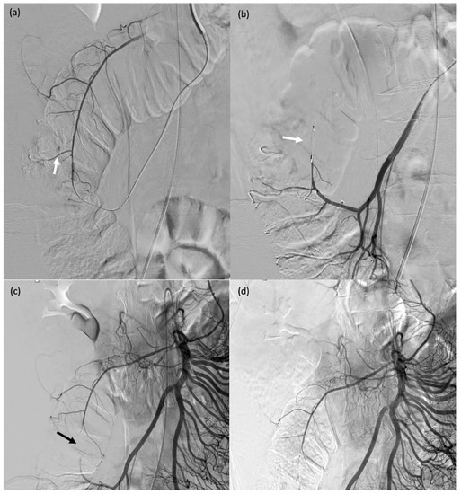Embolisation Using Microvascular Plugs for Peripheral Applications ...