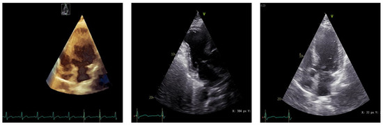 T and Small Protrusion (TAP) Technique in Bifurcations: Coronary Artery ...
