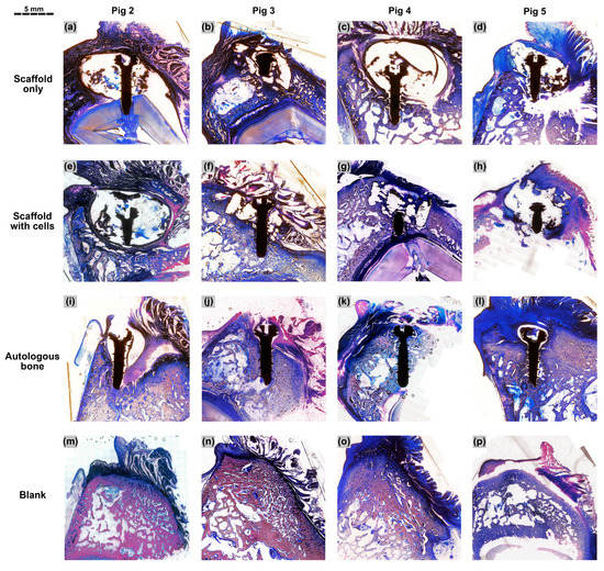 Alveolar Ridge Augmentation with a Novel Combination of 3D-Printed ...