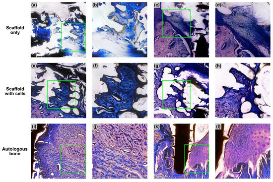 Alveolar Ridge Augmentation with a Novel Combination of 3D-Printed ...