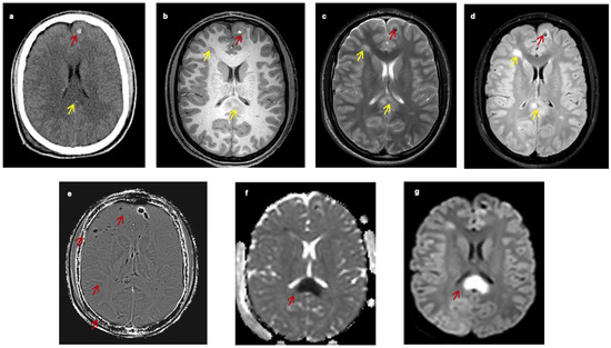 The Role of Novel Imaging and Biofluid Biomarkers in Traumatic Axonal ...