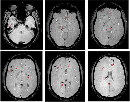 The Role of Novel Imaging and Biofluid Biomarkers in Traumatic Axonal ...