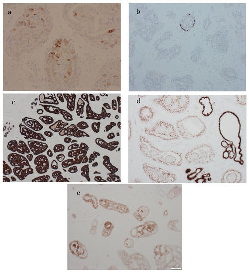 Tall Cell Carcinoma with Reversed Polarity: Case Report of a Rare ...