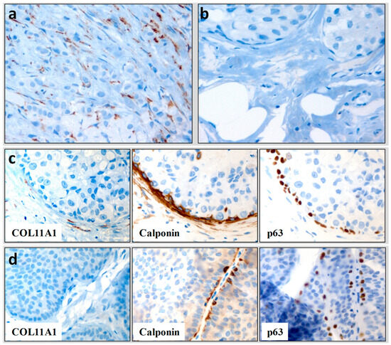 Usefulness of COL11A1 as a Prognostic Marker of Tumor Infiltration