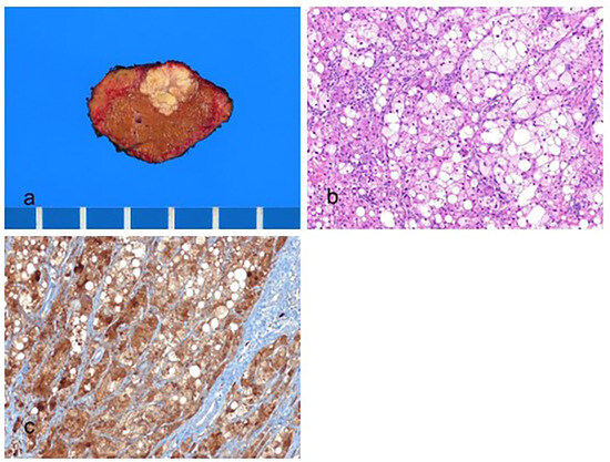 Advances in Histological and Molecular Classification of Hepatocellular ...