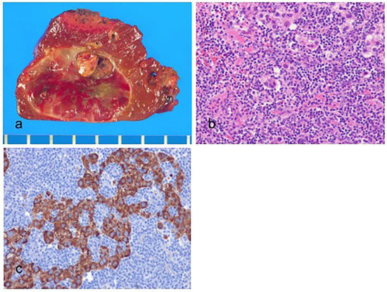 Advances in Histological and Molecular Classification of Hepatocellular ...