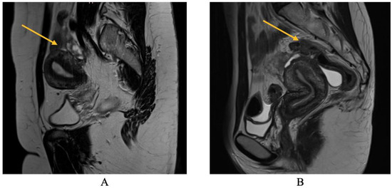 Transvaginal Ultrasound vs. Magnetic Resonance Imaging: What Is the ...