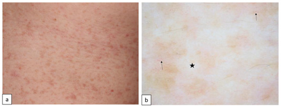 Dermoscopic Patterns of Genodermatoses: A Comprehensive Analysis