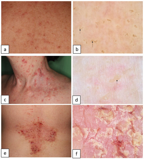 Dermoscopic Patterns of Genodermatoses: A Comprehensive Analysis