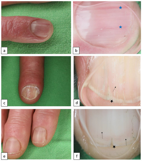 Dermoscopic Patterns of Genodermatoses: A Comprehensive Analysis