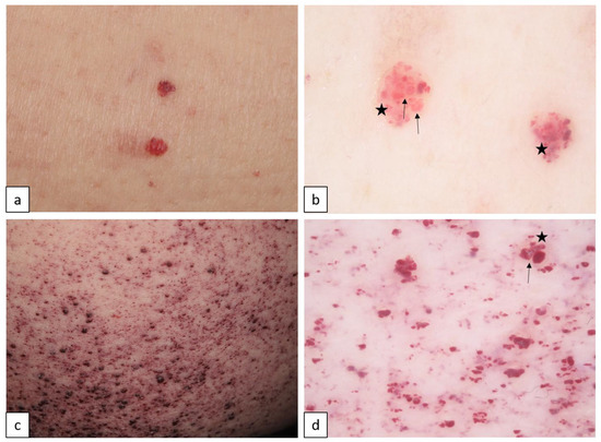 Dermoscopic Patterns of Genodermatoses: A Comprehensive Analysis