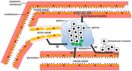 Peritumoral Edema in Gliomas: A Review of Mechanisms and Management
