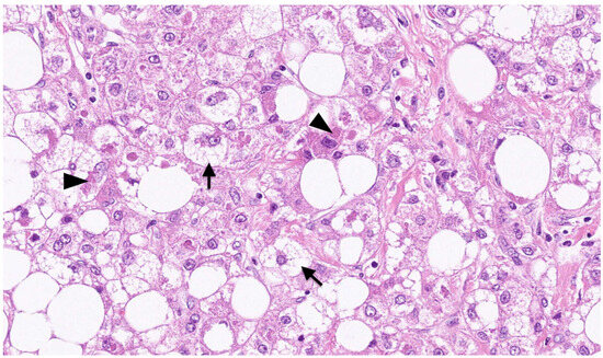 Pathology and Pathogenesis of Metabolic Dysfunction-Associated ...