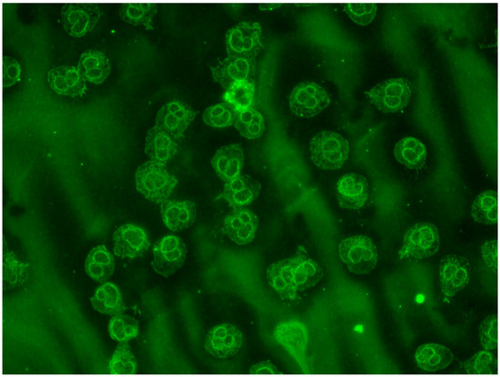 A Rare Case of Anca Positivity and Antiphospholipid Antibodies in a ...