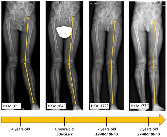 Tibia Valga Correction by Extraperiosteal Fibular Release in Multiple ...