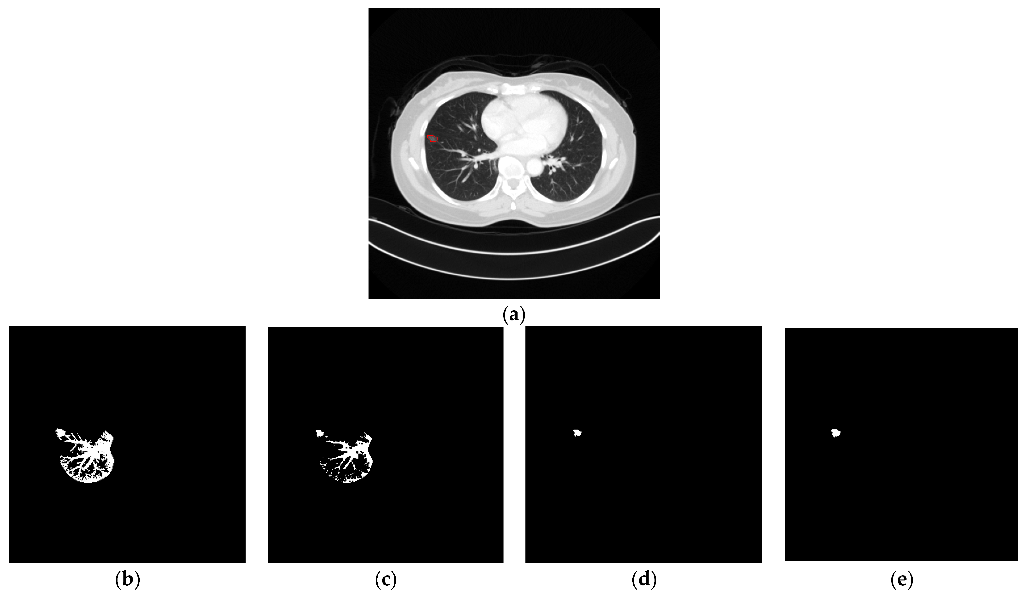 Biomedicines | Free Full-Text | Effective Invasiveness Recognition of Imbalanced Data by Semi ...