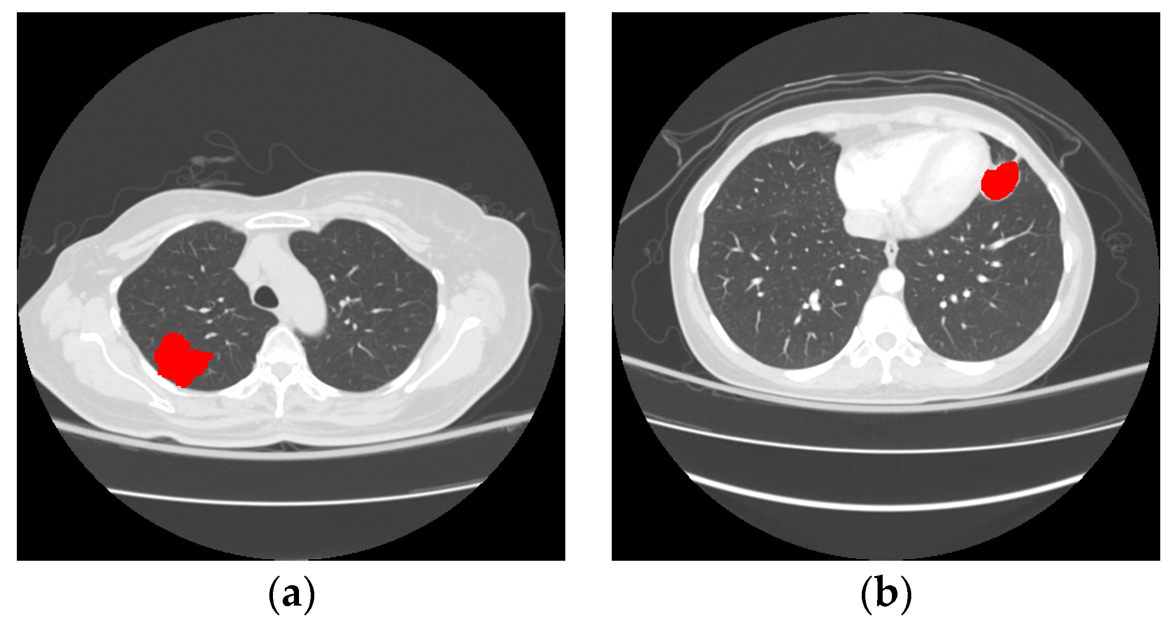 Biomedicines | Free Full-Text | Effective Invasiveness Recognition of ...