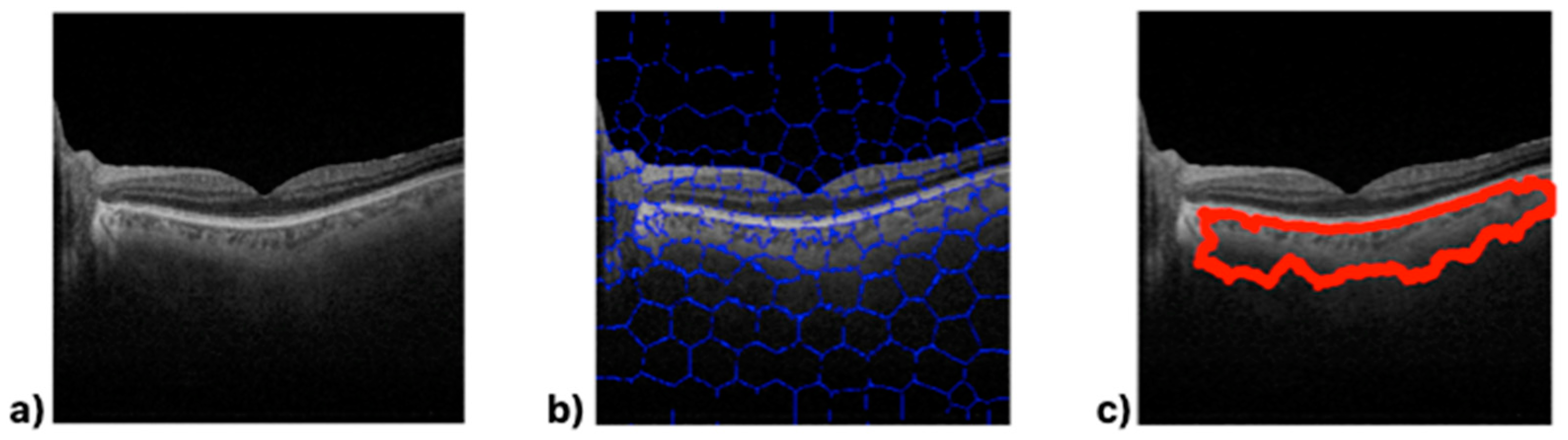 Detecting Structural Changes in the Choroidal Layer of the Eye in Neurodegenerative Disease ...