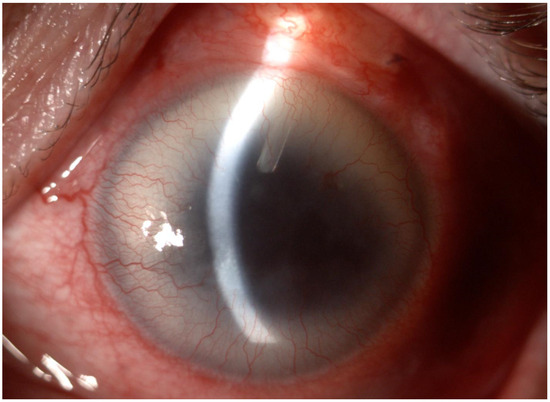 Long-Term Clinical Outcomes of Ahmed Valve Implantation in Aniridic ...