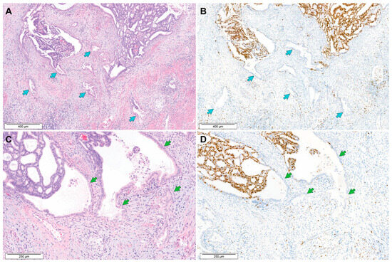 Biomedicines | Free Full-Text | Endocervical Adenocarcinoma Showing ...