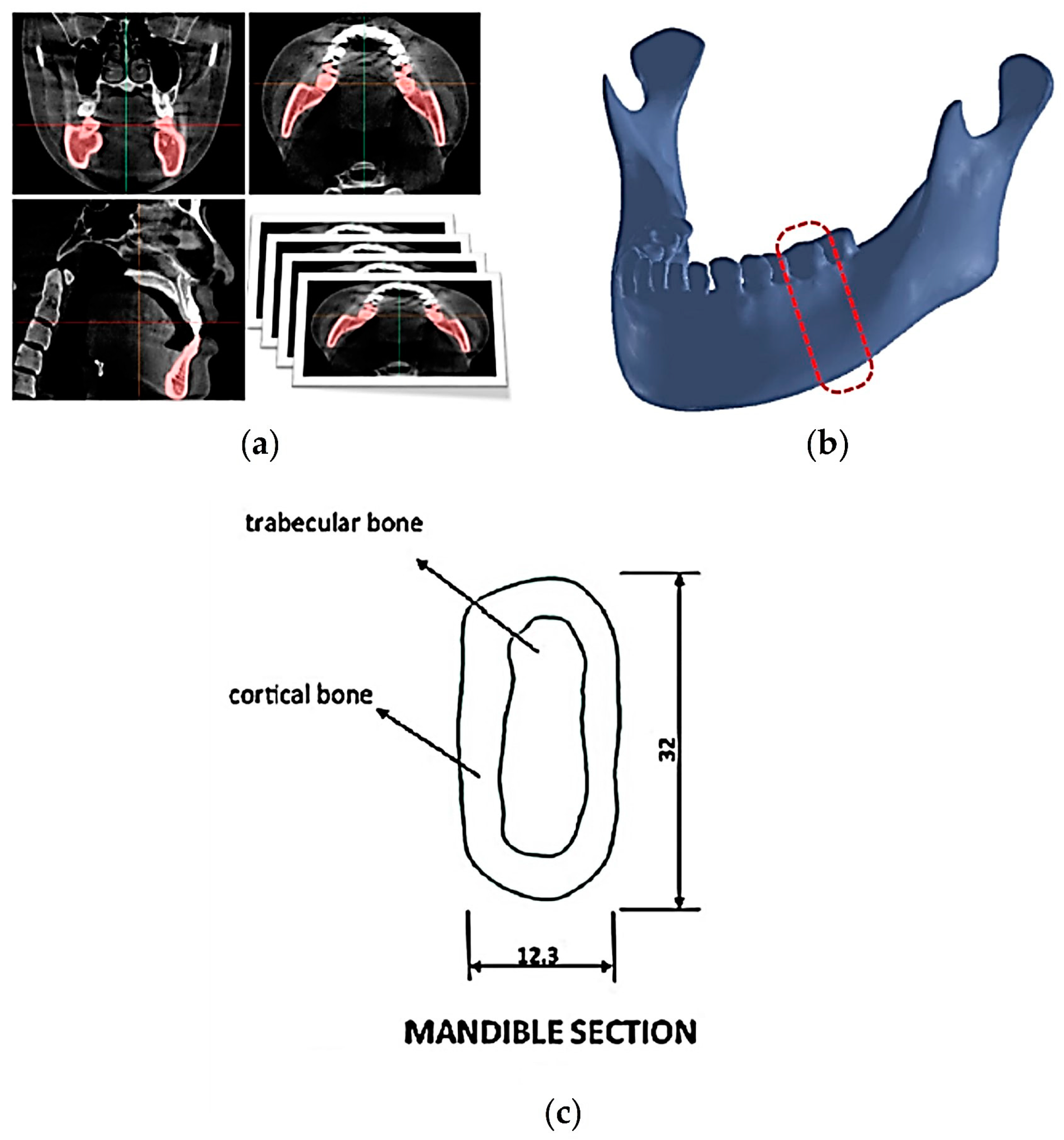 Crestal and Subcrestal Placement of Morse Cone Implant–Abutment ...